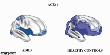 adhd brain - Imgflip