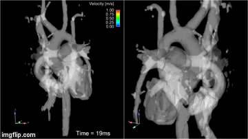 Dynamic MRI Of Heart Imploding/Vortexing Blood - Imgflip