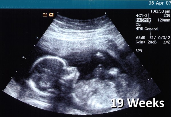 Ultrasound Blank Template Imgflip