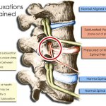 Lumbar Subluxations Meme Generator - Imgflip