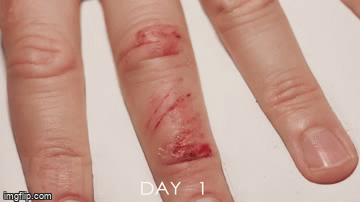 TIME LAPSE OF A WOUND HEALING ON A FINGER. - Imgflip