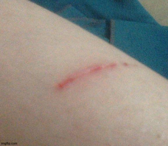 (Old picture, it recovered)ouchie ouchie - Imgflip