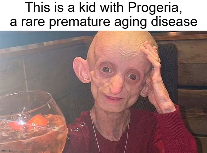 Memes Progeria They May Appear Normal At Birth And Age Within First