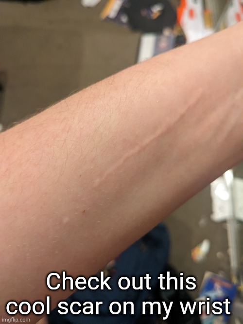 I got it from a surgery back in 2019 after I broke my wrist - Imgflip