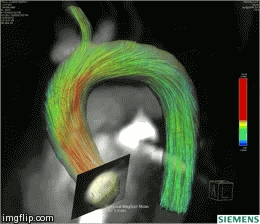 4D MRI flow imaging of the normal aorta - Imgflip