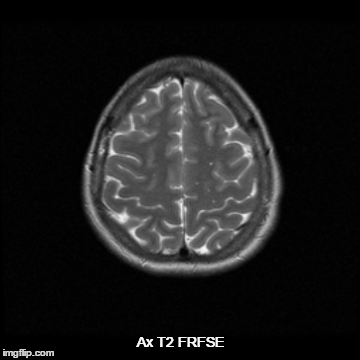 MRI Axial T2 - Imgflip