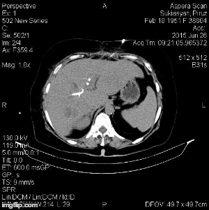 liver abscess .... - Imgflip
